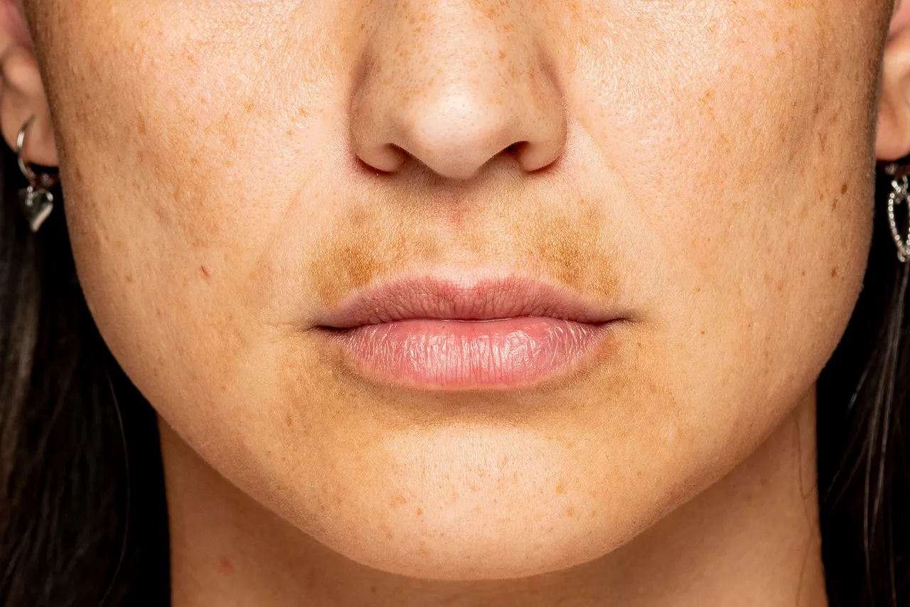 Hyperpigmentation : mes conseils pour atténuer ces tâches brunes